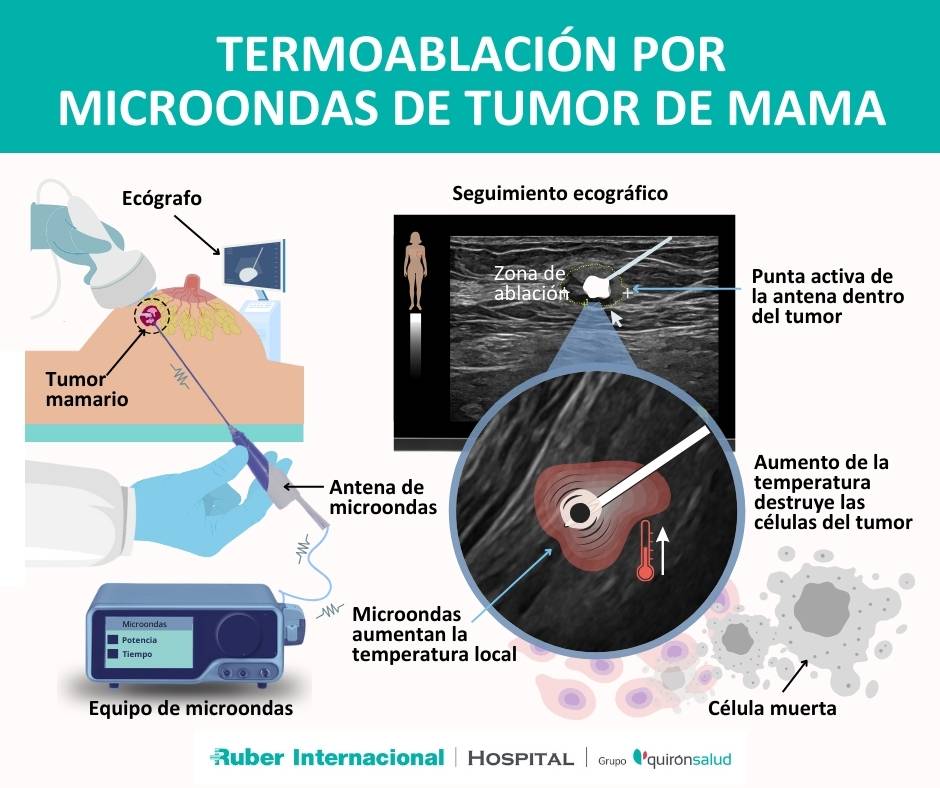 Termoablación por microondas para el tratamiento de tumores de mama